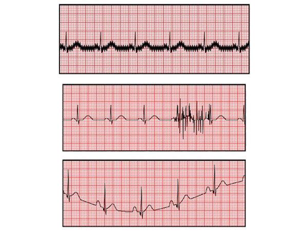 ECG Interference - Causes and Possible Solutions – DocStock